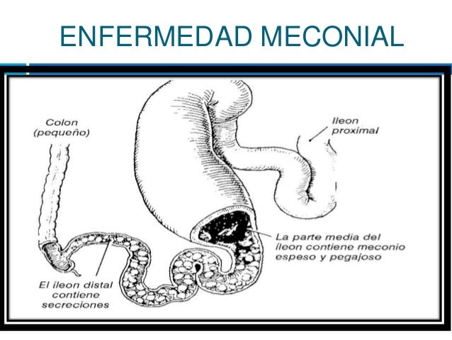 Enfermedad meconial