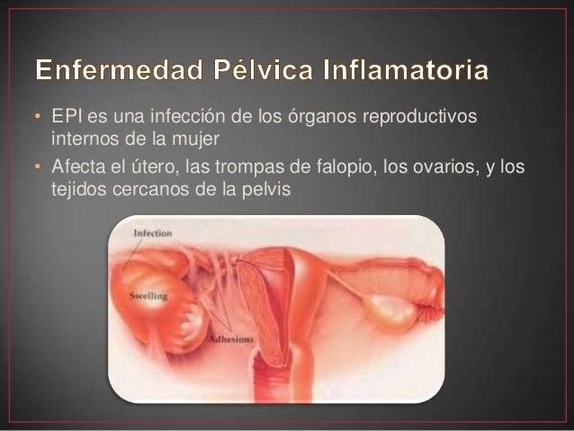 ¿Qué Es La Enfermedad Pélvica Inflamatoria – EXJCD