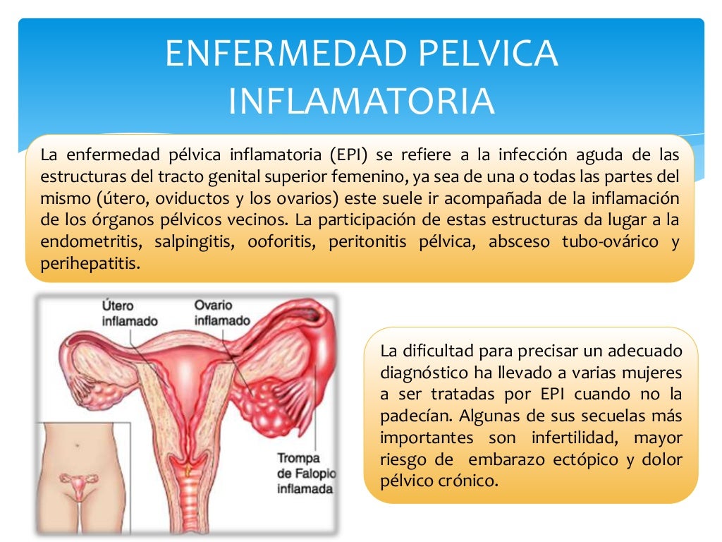 Enfermedad pelvica inflamatoria 2014