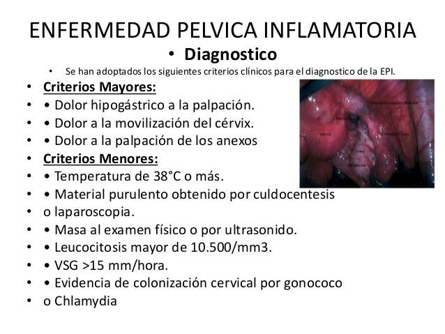 Enfermedad pelvica inflamatoria