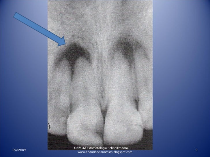 Enfermedad Periapical B