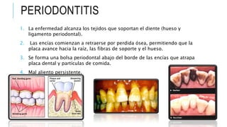 Enfermedad periodontal | PPTX