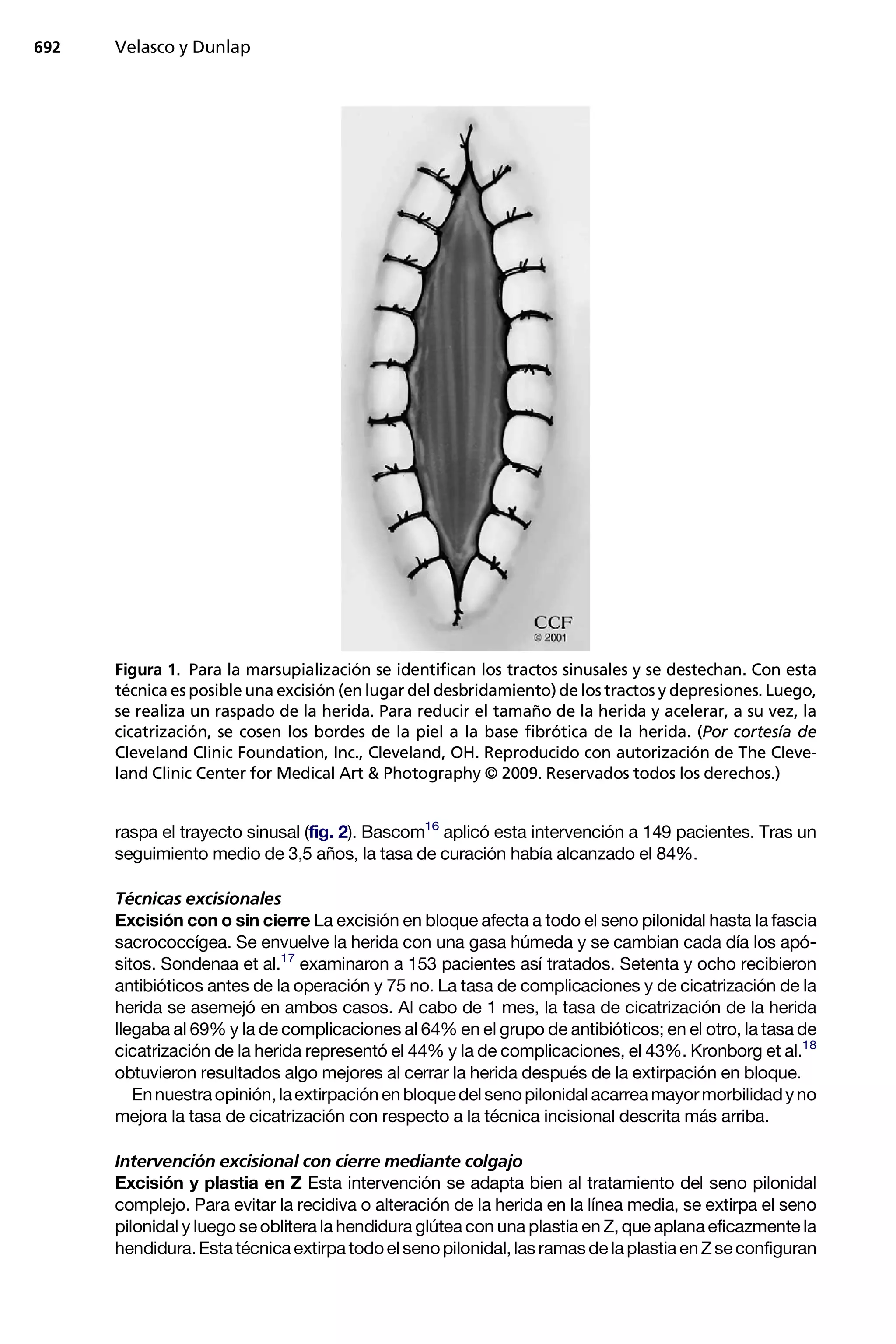 Enfermedad pilonidal e hidradenitis | PDF