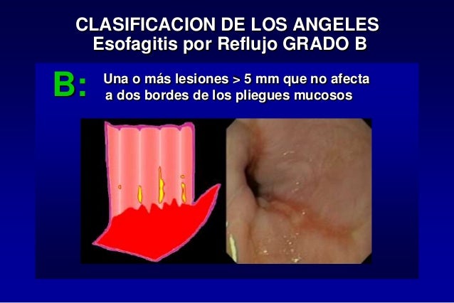 Que Es Esofagitis Por Reflujo Grado A - Descargar Fortnite