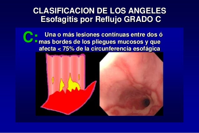 Que Es Esofagitis Grado C De Los Angeles - Descargar Video