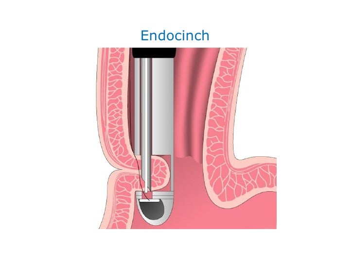 Barrett's Wessex - Endoluminal Gastroplication