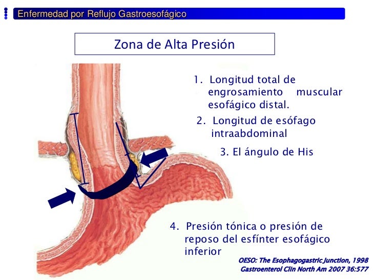 Enfermedad por reflujo gastroesofágico