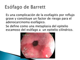 Enfermedad por reflujo gastroesofágico | PPTX