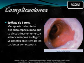 Enfermedad por reflujo gastroesofágico | PPTX