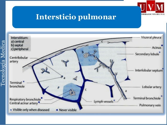 Enfermedad pulmonar