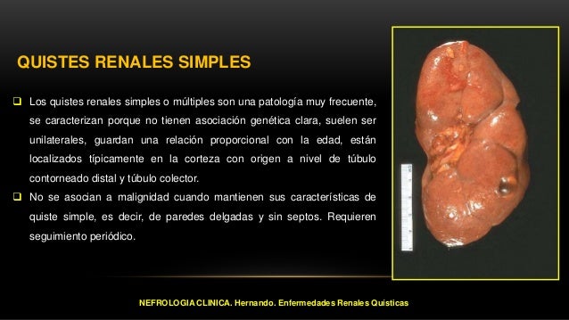 NEFROLOGIA CLINICA: Enfermedad renal quistica
