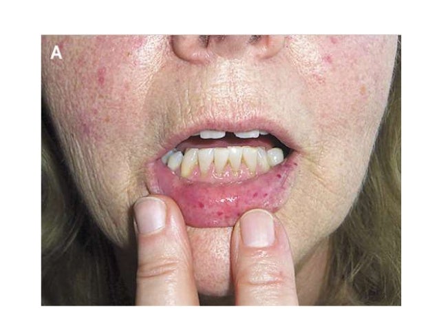 Enfermedad rendu osler-weber