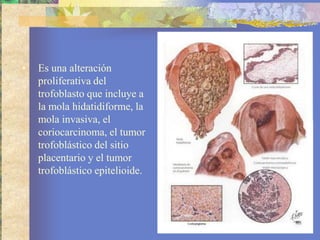 Enfermedad trofoblastica gestacional | PPTX | Pregnancy | Reproductive ...
