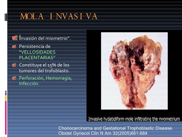 Enfermedad Trofoblastica Gestacional