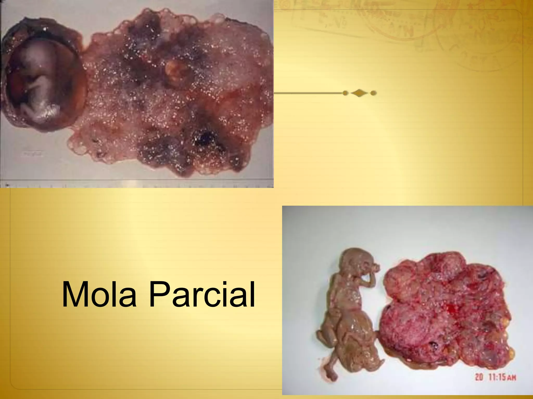 Mola hidatidiforme, Mola parcial, Mola completa, Enfermedad ...