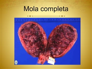 Mola hidatidiforme, Mola parcial, Mola completa, Enfermedad ...