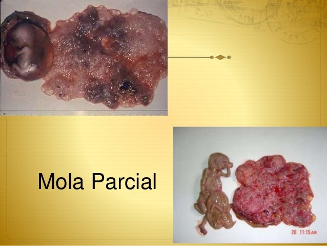 Mola hidatidiforme, Mola parcial, Mola completa, Enfermedad Trofoblás…