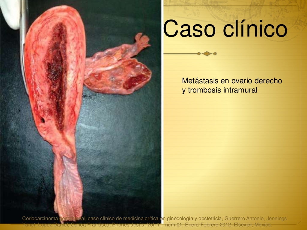 Mola hidatidiforme, Mola parcial, Mola completa, Enfermedad Trofoblás…