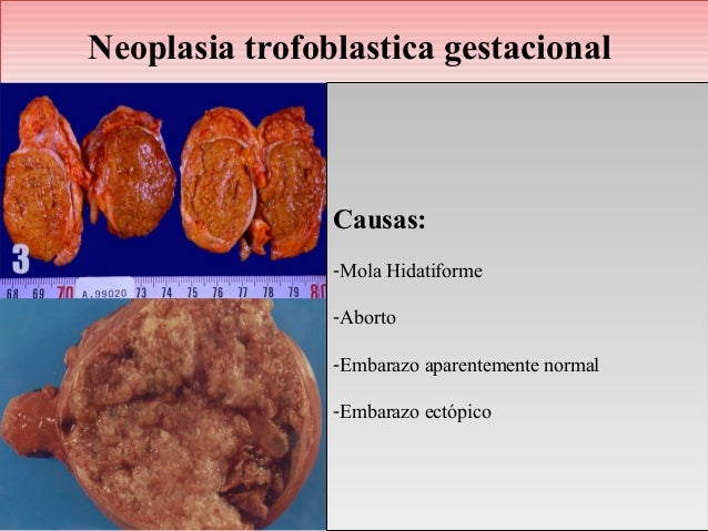 Enfermedad trofoblastica gestacional