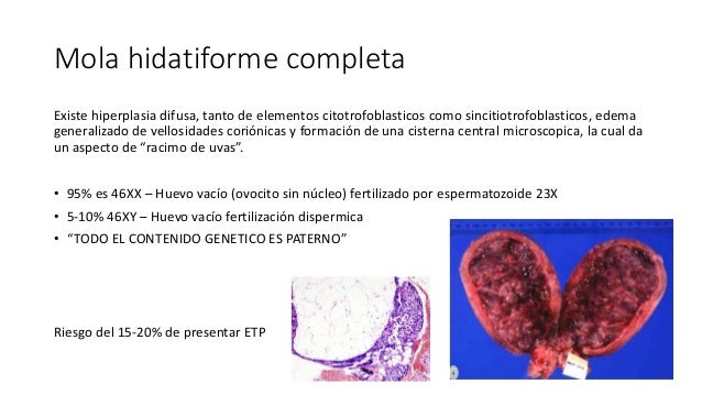 Mola Hidatiforme