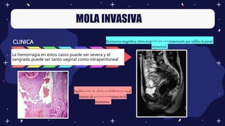Enfermedad trofoblástica gestacional-Ginecología y obstetricia.pptx