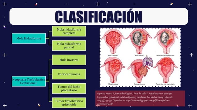 Enfermedad trofoblástica gestacional-Ginecología y obstetricia.pptx ...