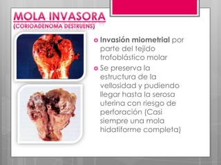 Enfermedad trofoblastica gestacional | PPTX