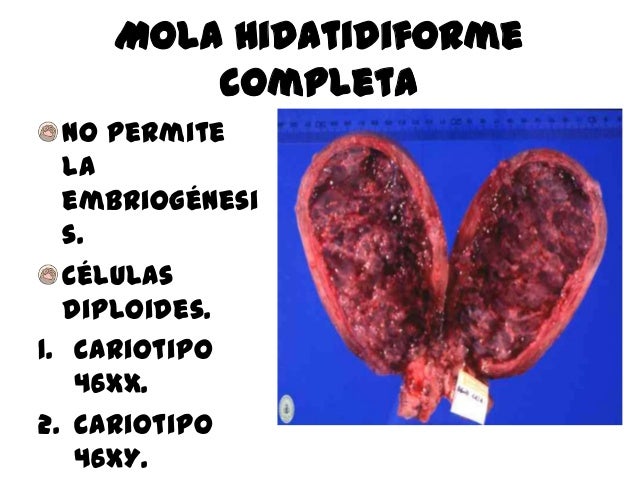 Enfermedad trofoblástica gestacional