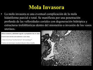Enfermedad Trofoblástica Gestacional: Mola Hidatidiforme | PPTX