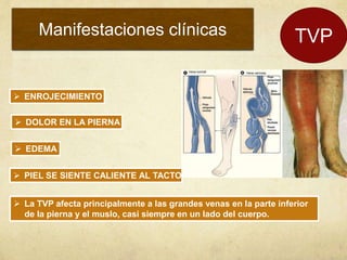 Enfermedad tromboembólica venosa | PPTX