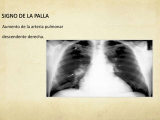 Enfermedad tromboembólica venosa | PPTX