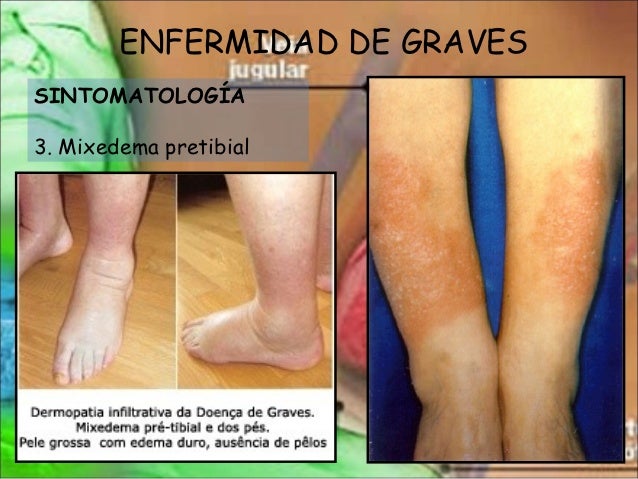 Enfermidad de graves