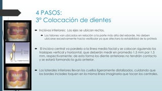 Seminario 4: Enfilado Dentario en Prótesis Removible | PPTX