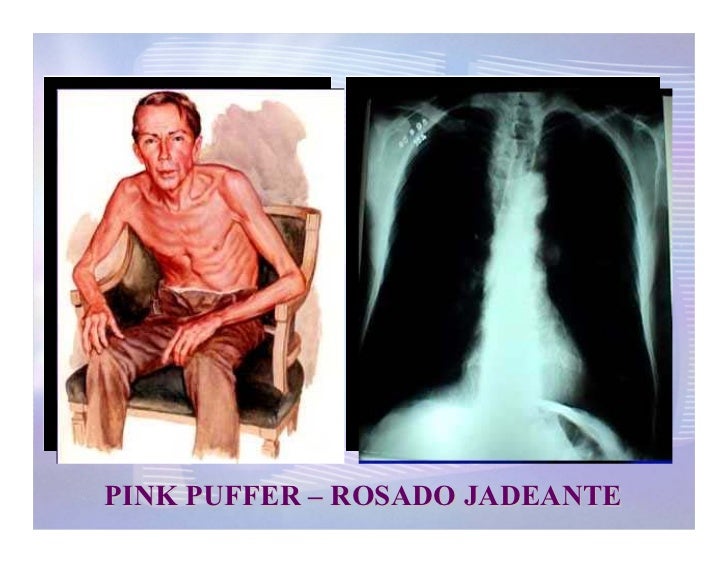 Enfisema