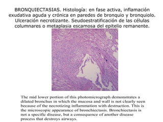 Enfisema Pulmonar Ppt