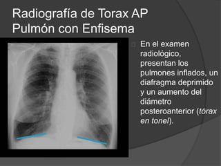 Enfisema pulmonar | PPT