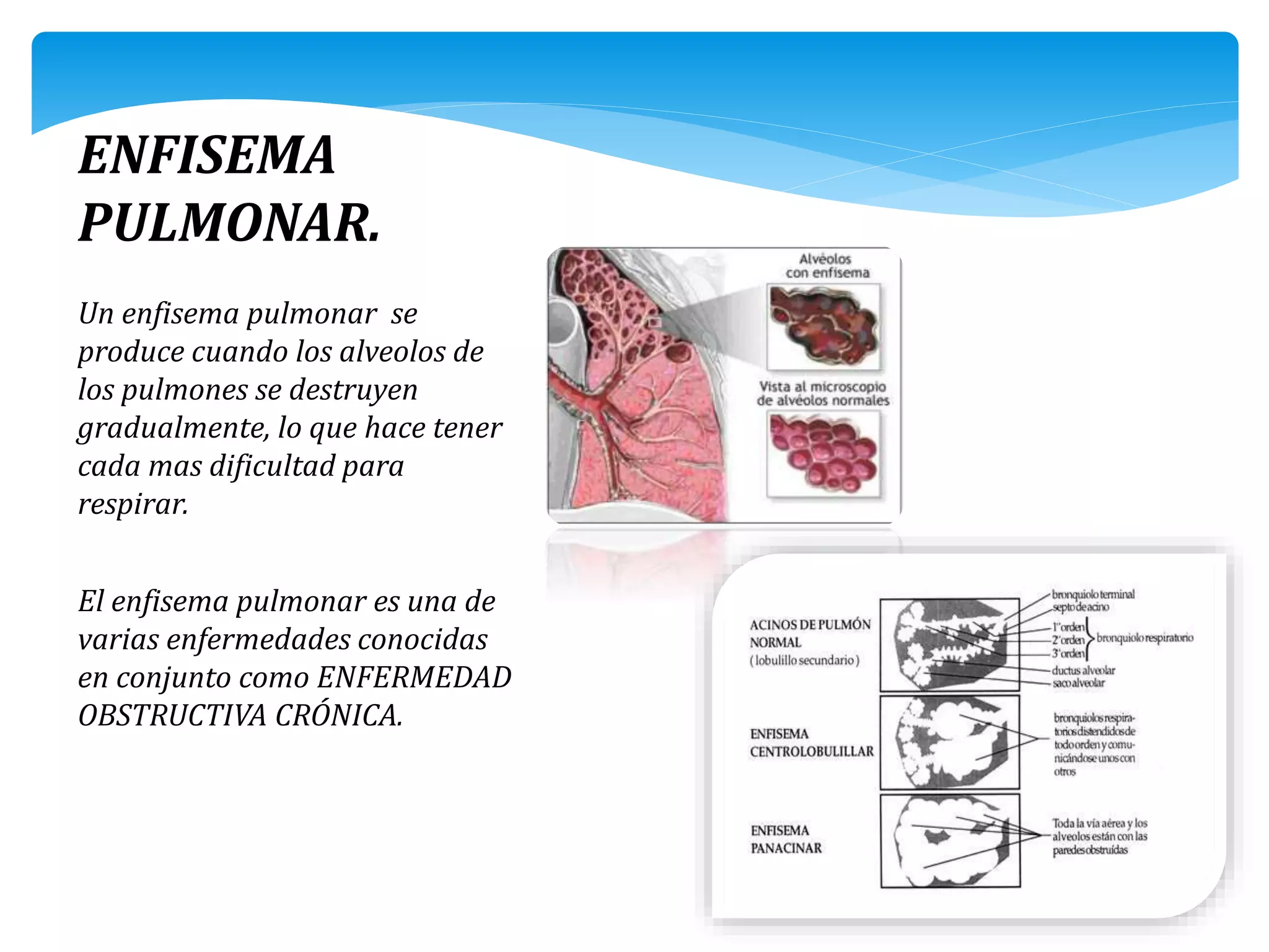 Enfisema pulmonar | PPTX | Lung and Respiratory Health | Diseases and ...
