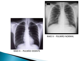 Enfisema Pulmonar.pptx