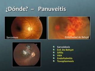 Enfoque diagnostico del paciente con uveitis | PPTX