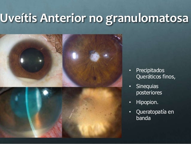 Enfoque diagnostico del paciente con uveitis