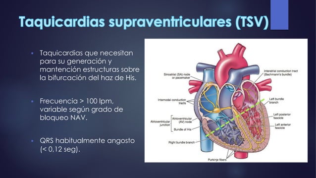 Enfrentamiento de las taquicardias paroxísticas supraventriculares ...