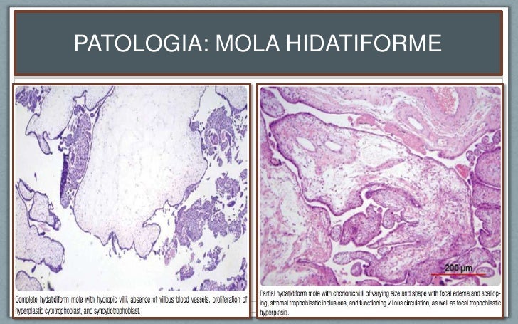 Enfermedad trofoblástica Gestacional