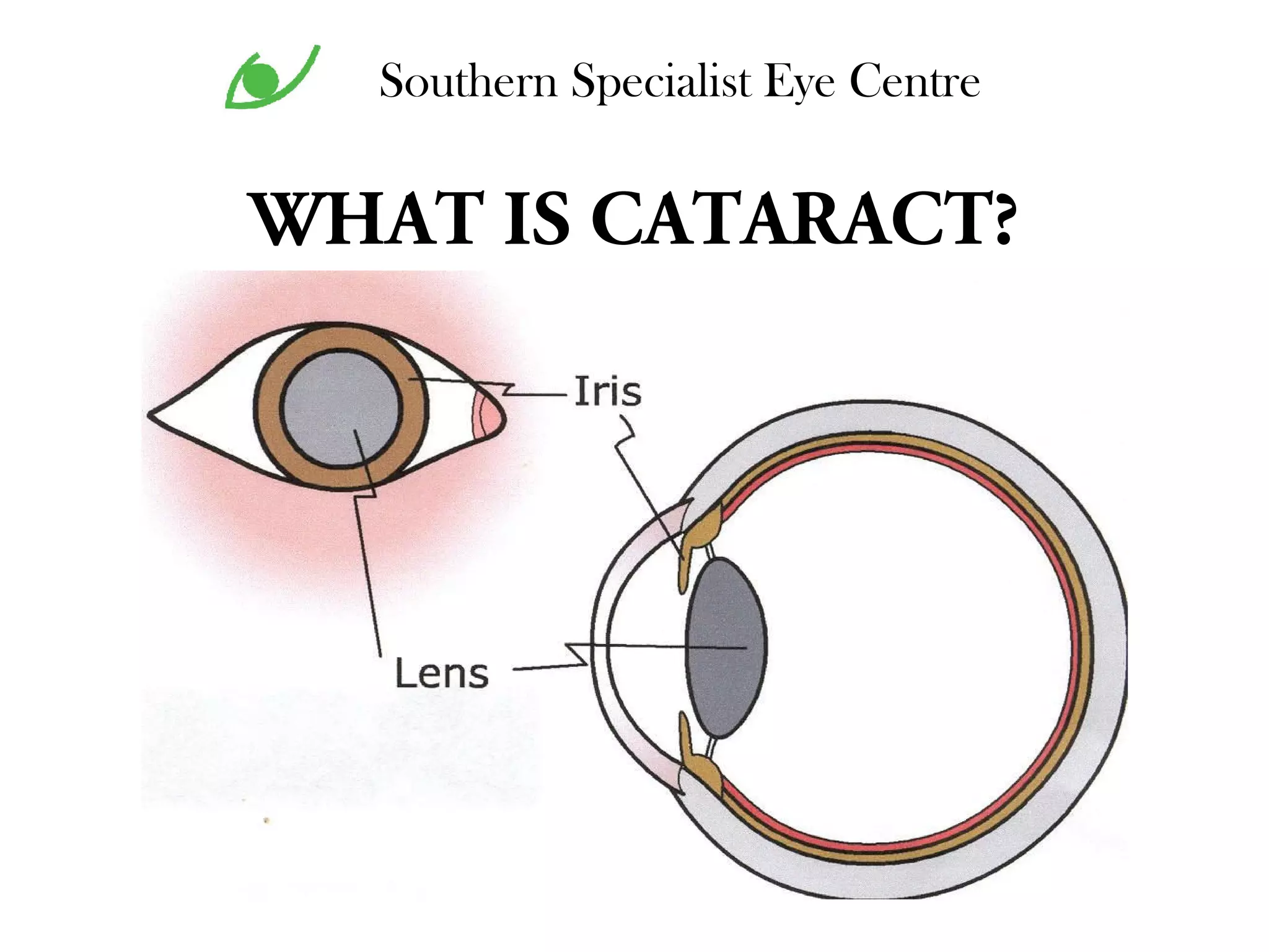 Eng cataract counselling ssec | PPT | Eye and Vision Conditions ...
