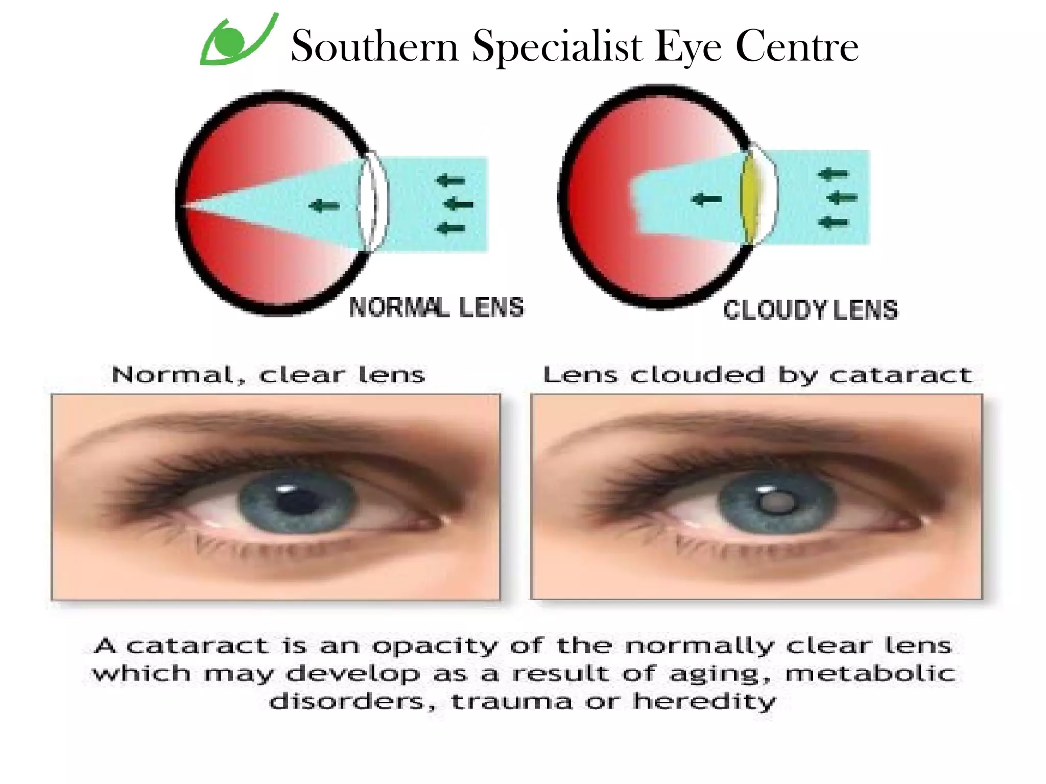 Eng cataract counselling ssec | PPT | Eye and Vision Conditions ...