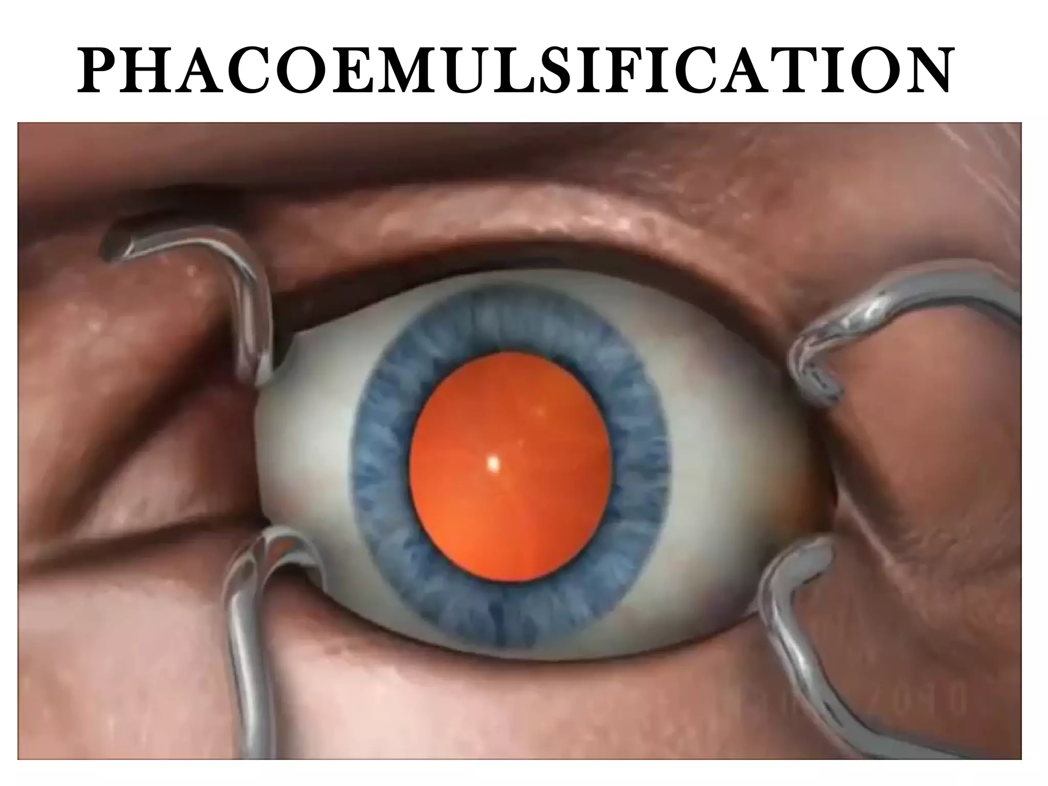 Eng cataract counselling ssec | PPT | Eye and Vision Conditions ...