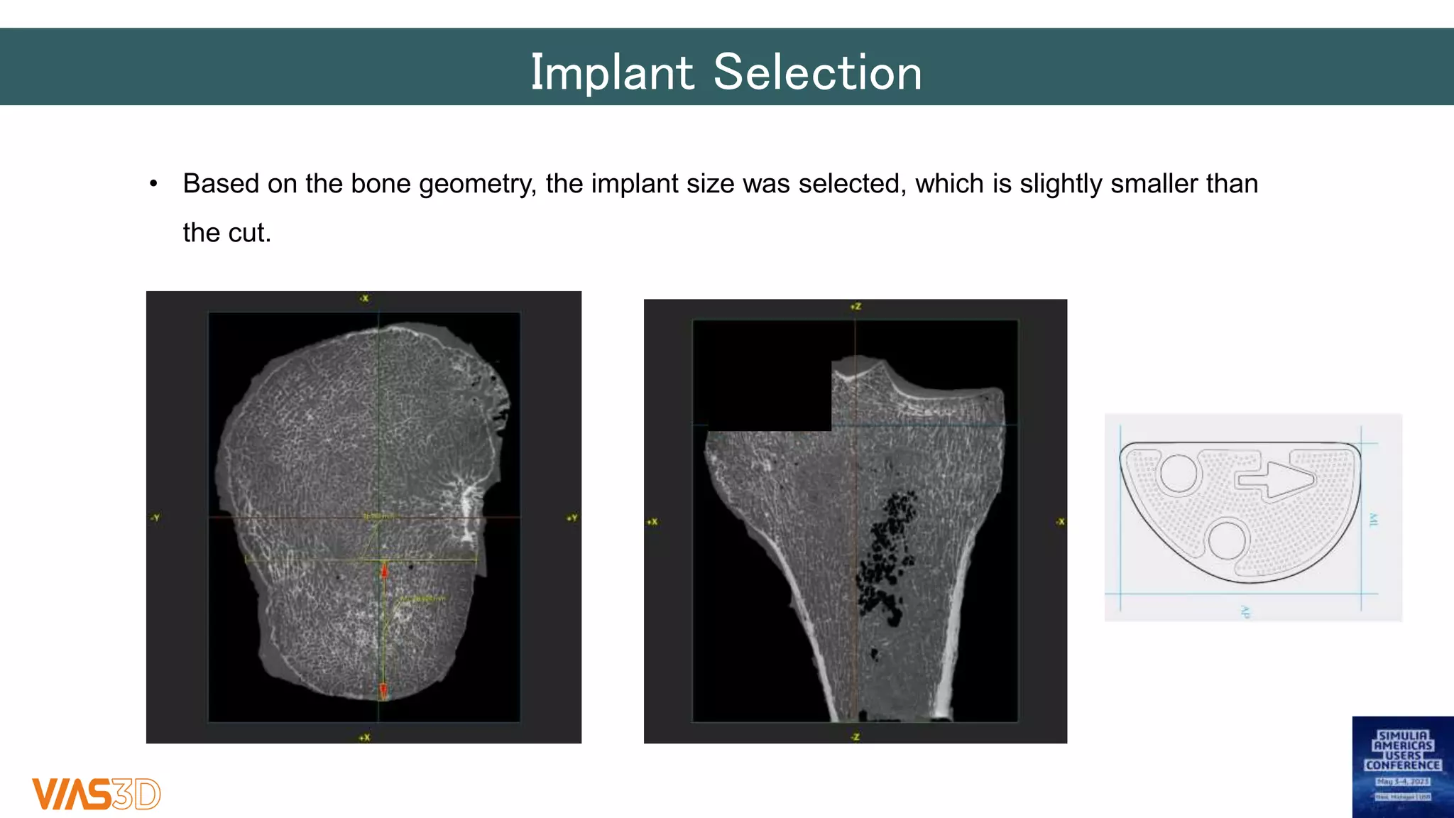 Engineered to Cure – Patient Specific Tibial Implant Design using Micro-Macro FEA Framework | PPT