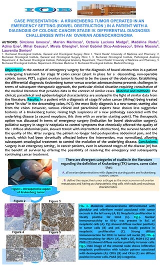 A Krukenberg tumor causing bowel obstruction in a patient known with ...