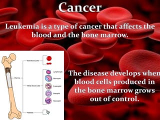 Leukemia Powepoit Presentation | PPTX