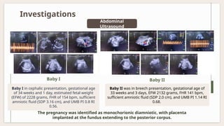 English Case_Monochorionic Diamniotic Twin Pregnancy with Severe ...