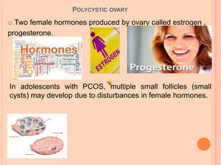 POLYCYSTIC OVARIAN SYNDROME IN ADOLESCENT GIRLS | PPTX